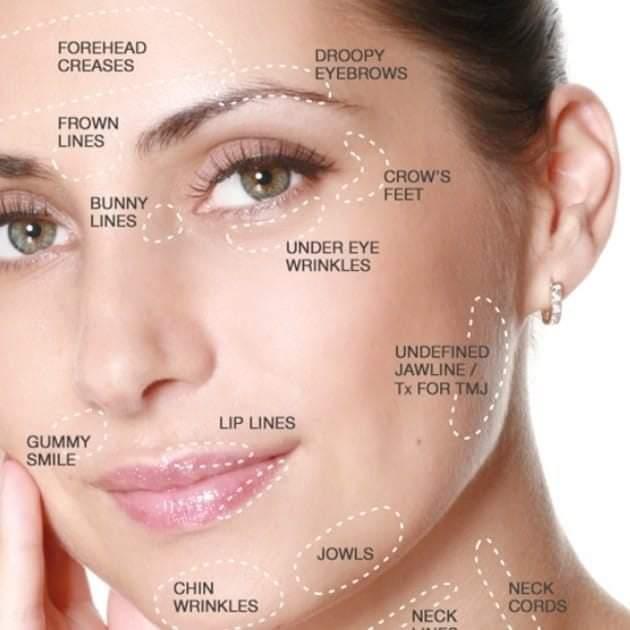 3 Areas botox